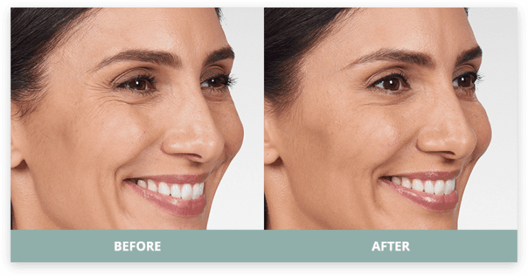 BOTOX in Charlotte, NC | Voci Med Spa