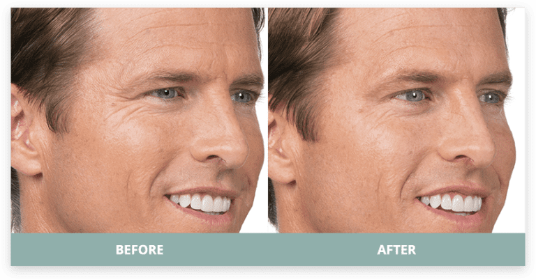 BOTOX in Charlotte, NC | Voci Med Spa