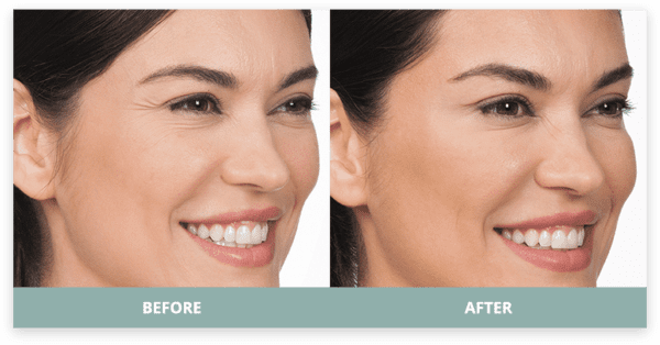 BOTOX in Charlotte, NC | Voci Med Spa